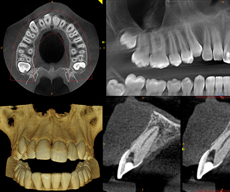 CBCT dental