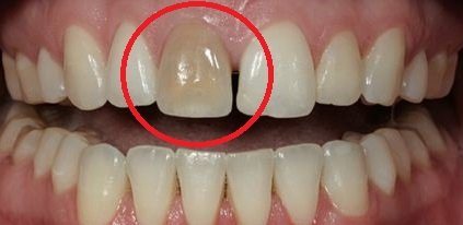 ¿Diente oscurecido? Causas y tratamiento