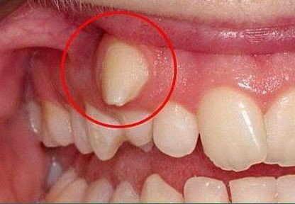 Dientes supernumerarios